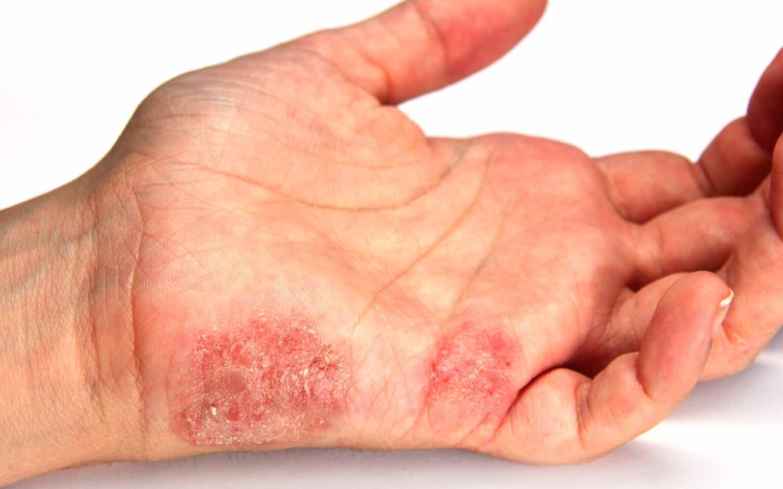 Hautpilz: Symptome, Ursachen, Bilder